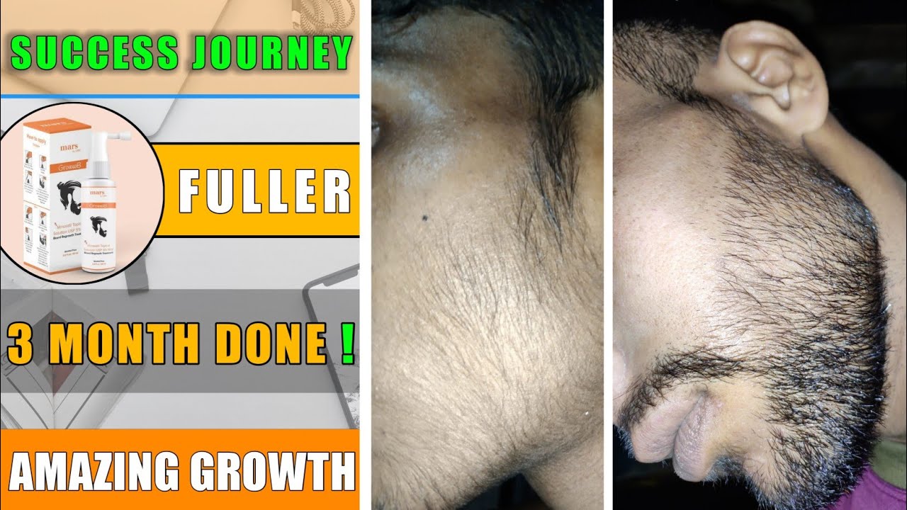 BEARD GROWTH || Get full beard tips for beginners || 3 Month done 👍 ...