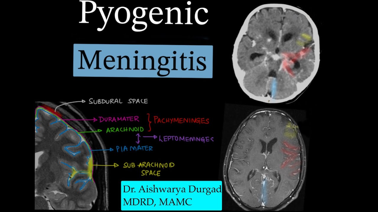 Pyogenic meningitis- discussion. Leptomeningeal enhancement ...