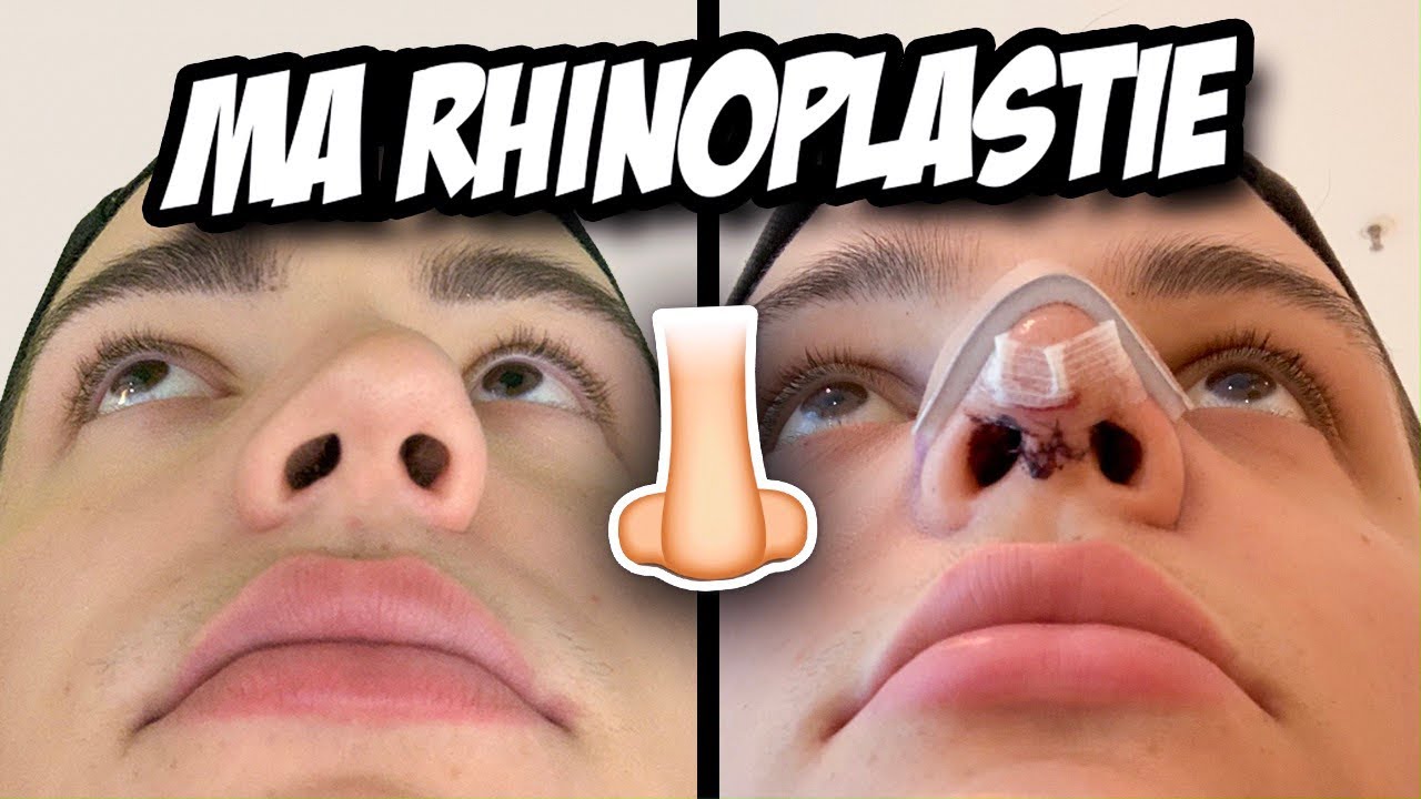 Ma Rhinoplastie Mon Expérience Prix Avantaprès Youtube