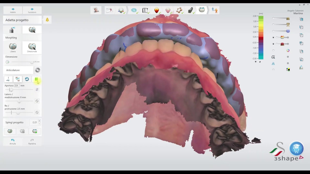 3Shape Splint Studio: breve presentazione del nuovo strumento targato ...