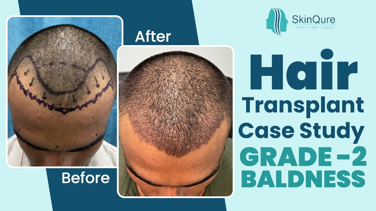 Hair Transplant Case Study Grade 2 Baldness | Dr. Jangid | Best Hair ...