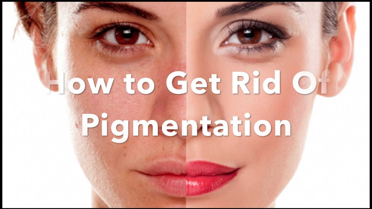 How To Get Rid Of Pigmentation YouTube how-to-get-rid-of-pigmentation-youtube