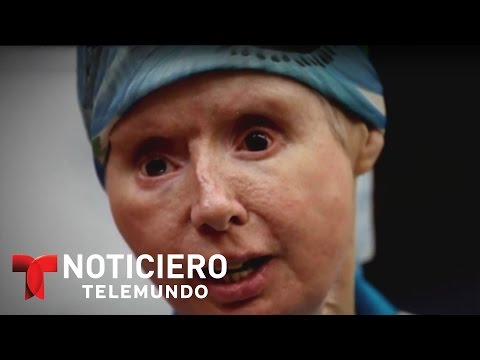 Revés para mujer a quien un chimpancé le arrancó la cara | Noticiero | Noticias Telemundo