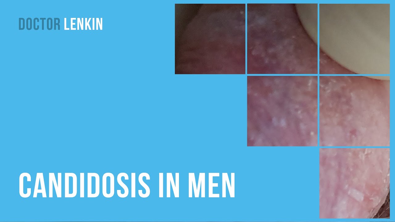 👉 Candidosis in men - YouTube
