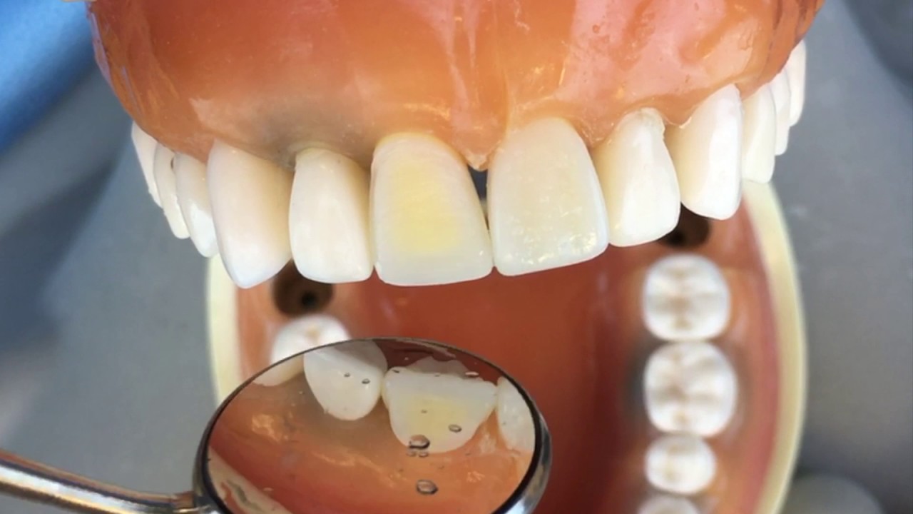 Porcelain Veneer Preparations with audio explanation - YouTube