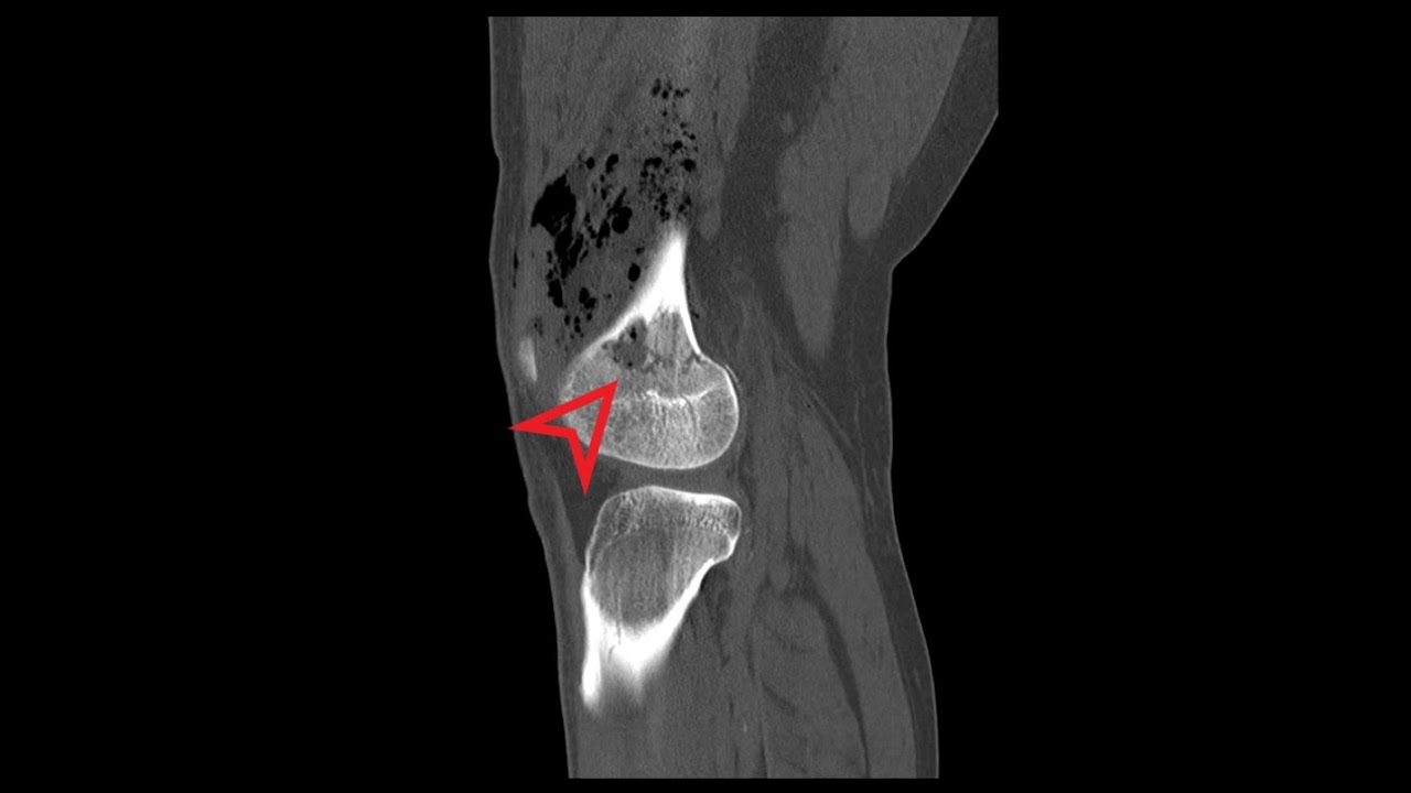 Knee CT: Traumatic Arthrotomy following Gun Shot Wound - YouTube
