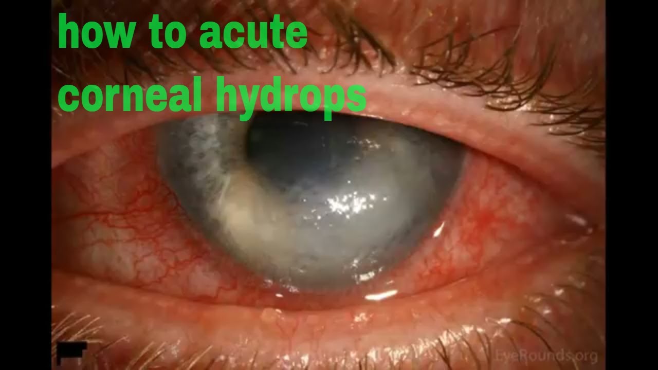 HOW TO ACUTE corneal hydrops - YouTube