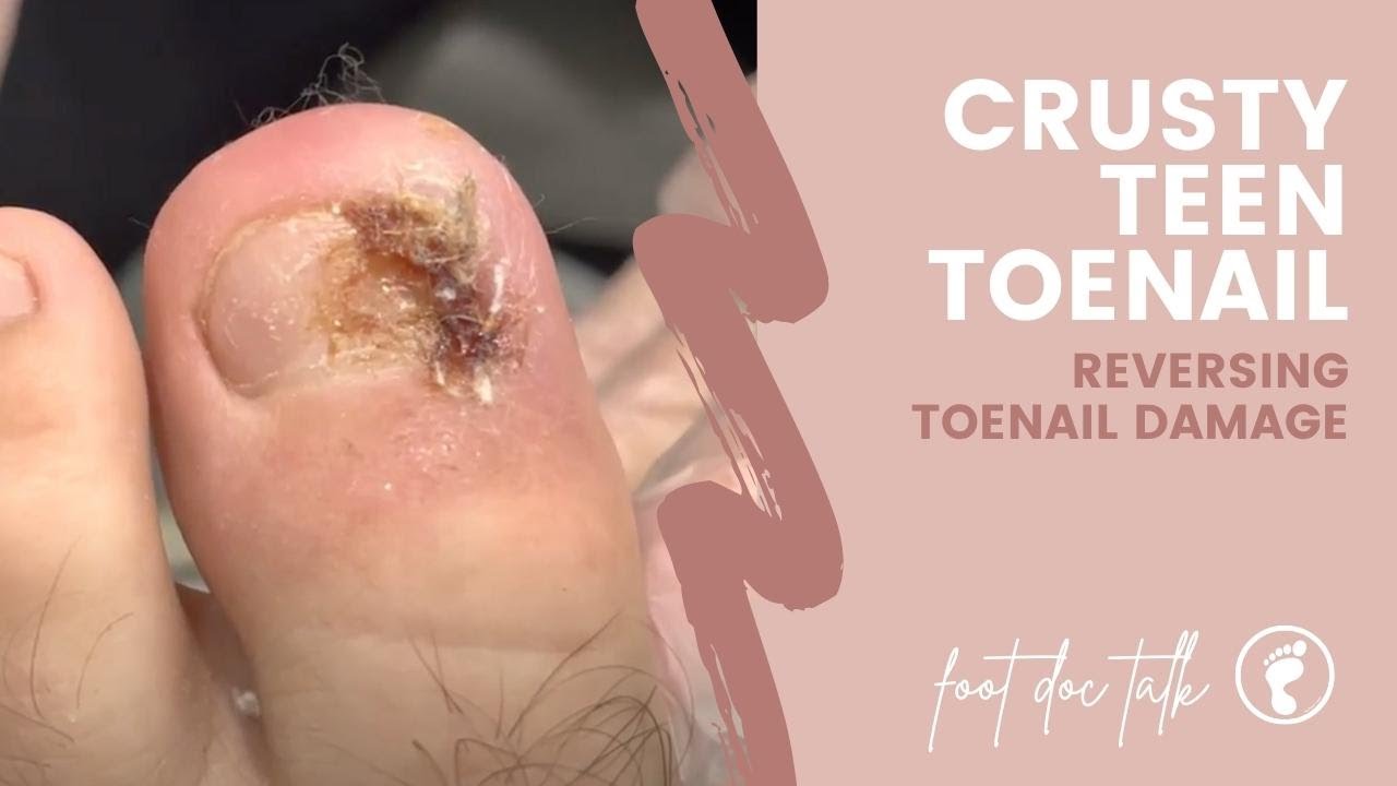 CRUSTY TEEN NAIL - YouTube