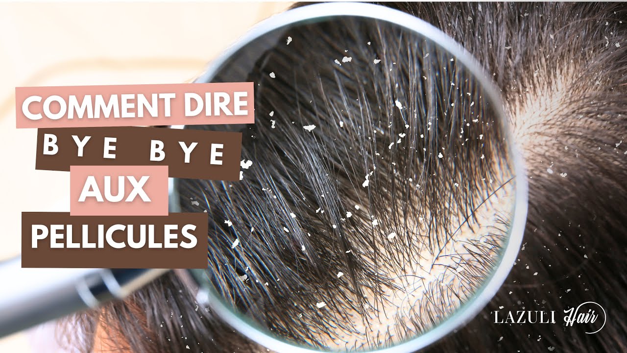Comment Se Débarrasser Définitivement Des Pellicules ? - LAZULI HAIR ...