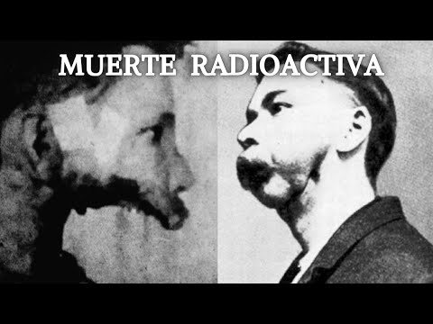 FUE AL DOCTOR POR UN DOLOR DE BRAZO Y TERMINÓ SIN MANDÍBULA 💀 La Muerte Radioactiva de Eben ...