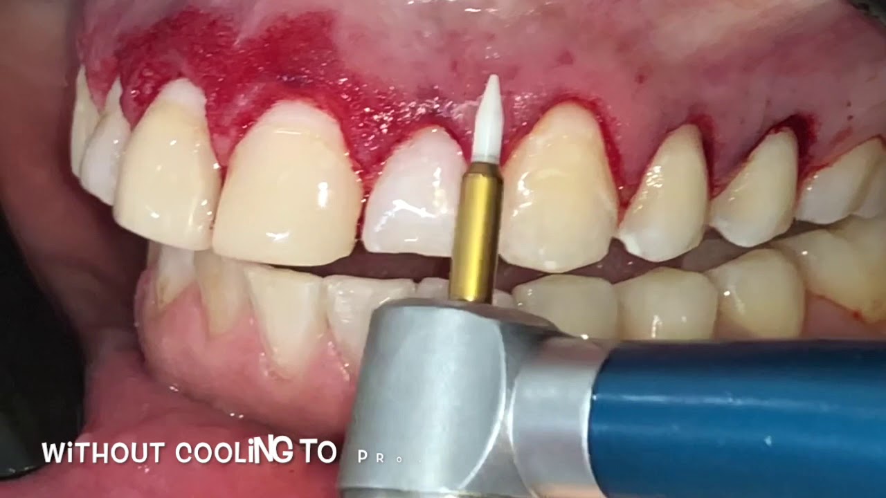 Gingival sculpture with ceramic burr - YouTube