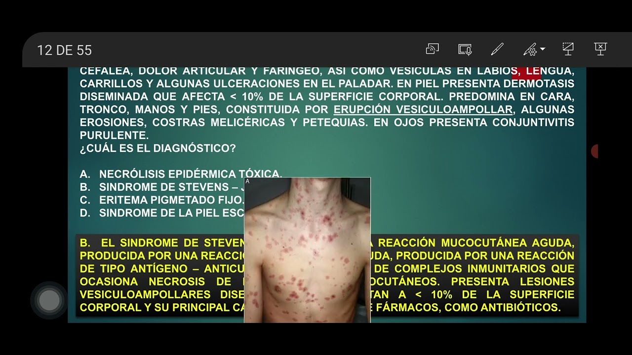 Caso Clínico N.8 Sindrome de Stevens Johnson (Dermatología) - YouTube