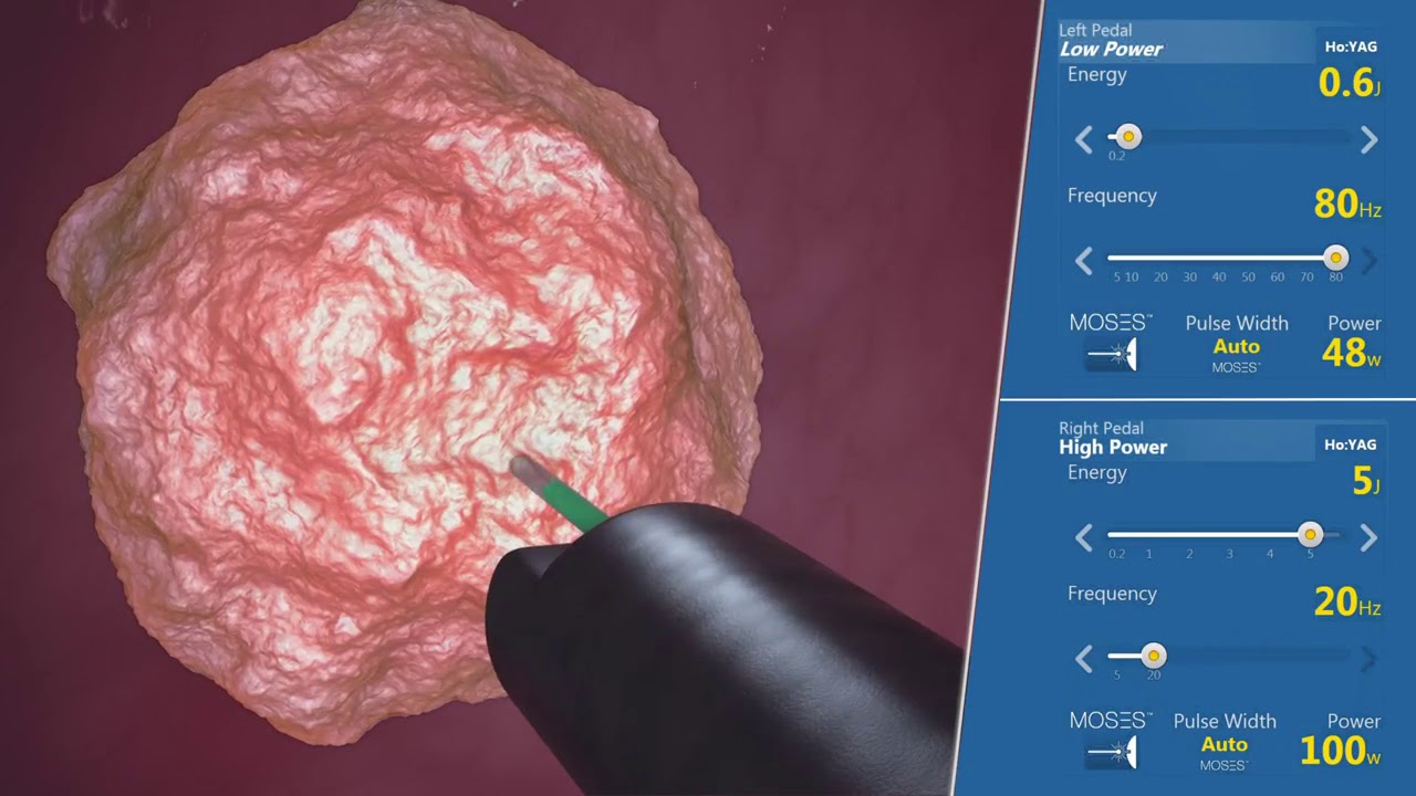 Lumenis MOSES Pulse 120H a Leading Innovation for Urinary Stone ...