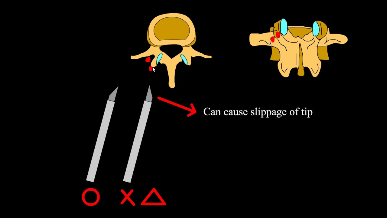 vertebroplasty, direction of bevel of needle - YouTube