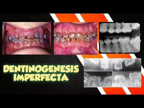 DEVELOPMENTAL ANAMOLIES OF TEETH - DENTINOGENESIS IMPERFECTA - YouTube