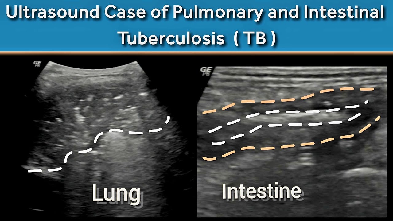 A Rare Case of Active Pulmonary and Intestinal Tuberculosis (TB ) in ...