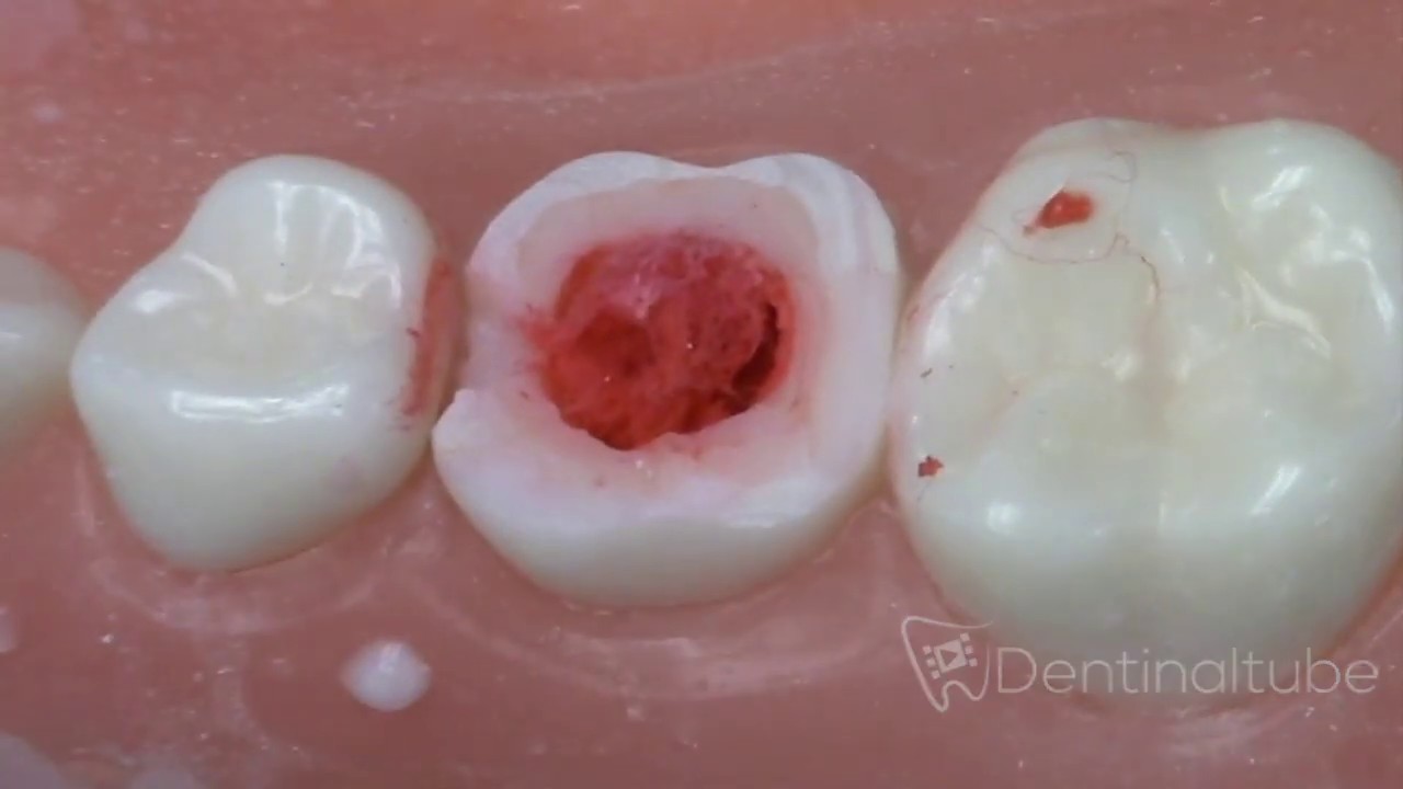 How to do a pulpotomy - YouTube