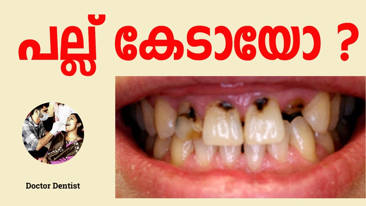പല്ല് കേട് | Tooth Decay explained | Doctor Dentist | - YouTube
