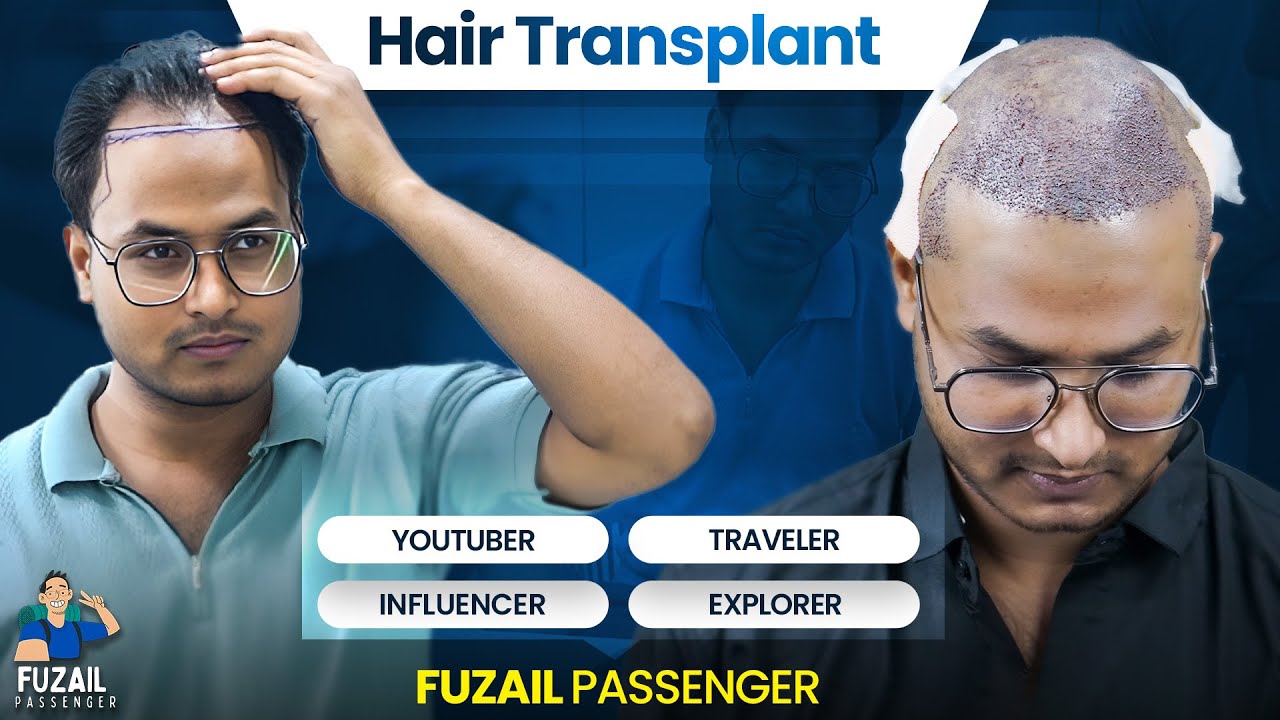 YouTuber Fuzail Passenger Hair Transplant | Experience Before and After Surgery #hairtransplant ...