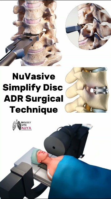 NuVasive - Simplify Disc - ADR Surgical Technique #medical #animation ...