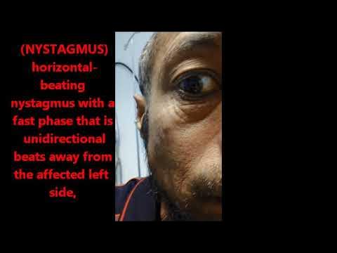 HINTS test//how to differentiate vestibular neuritis and central ...