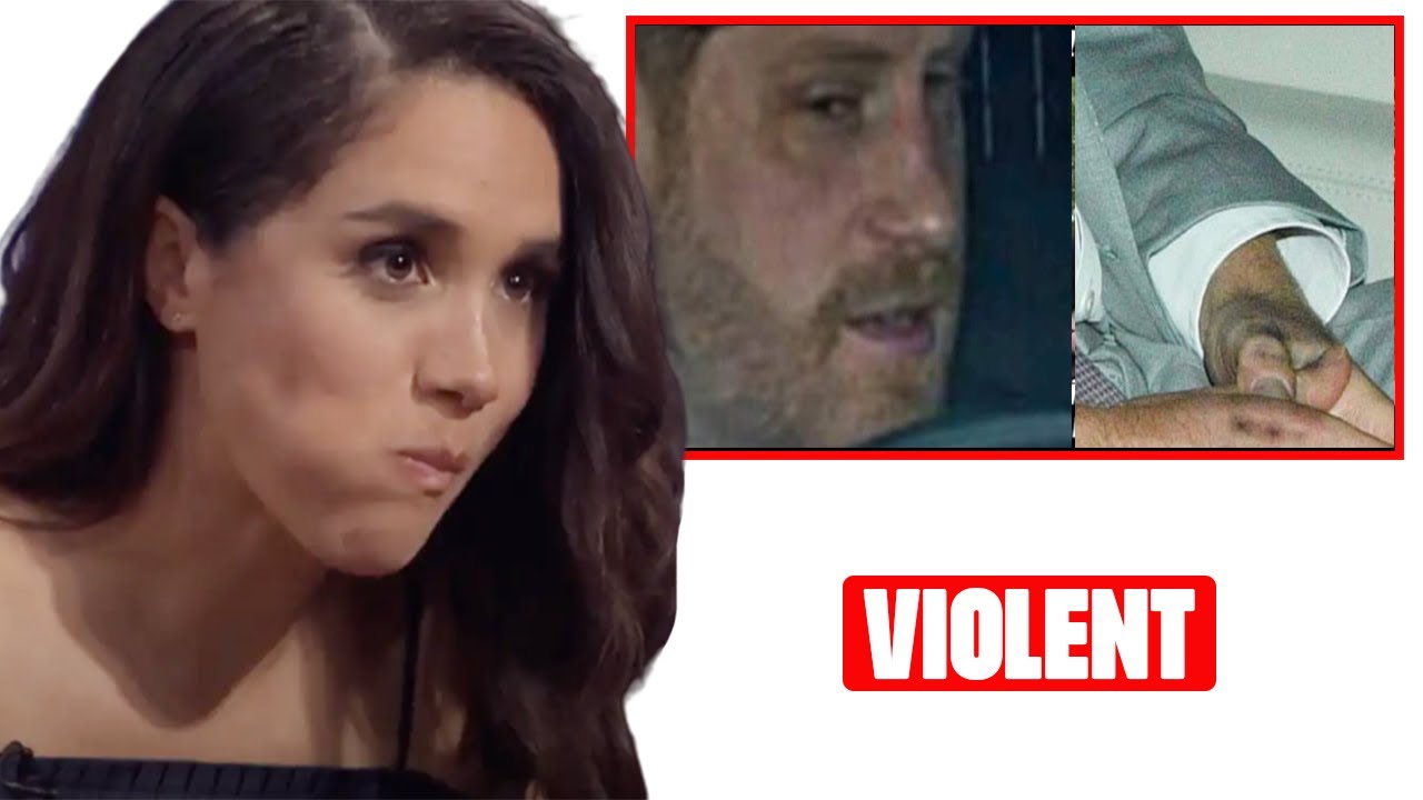 MEGHAN'S AB*SIVE? Harry Left Montecito With Bruises And Bite Marks ...