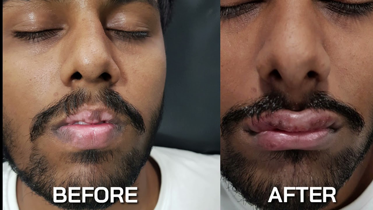 Vitiligo Repigmentation Tattoos Does Paramedical Tattoo Work?