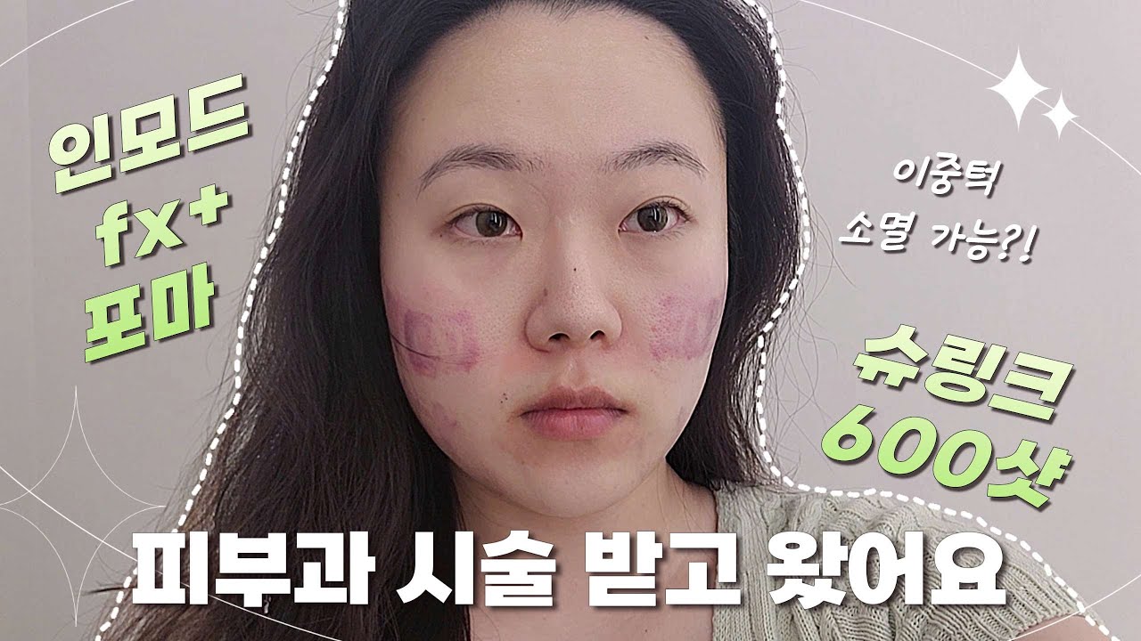 인모드 fx&forma 얼굴전체 1회차 / 슈링크 600샷 후기! 이중턱 사라질까...? - YouTube