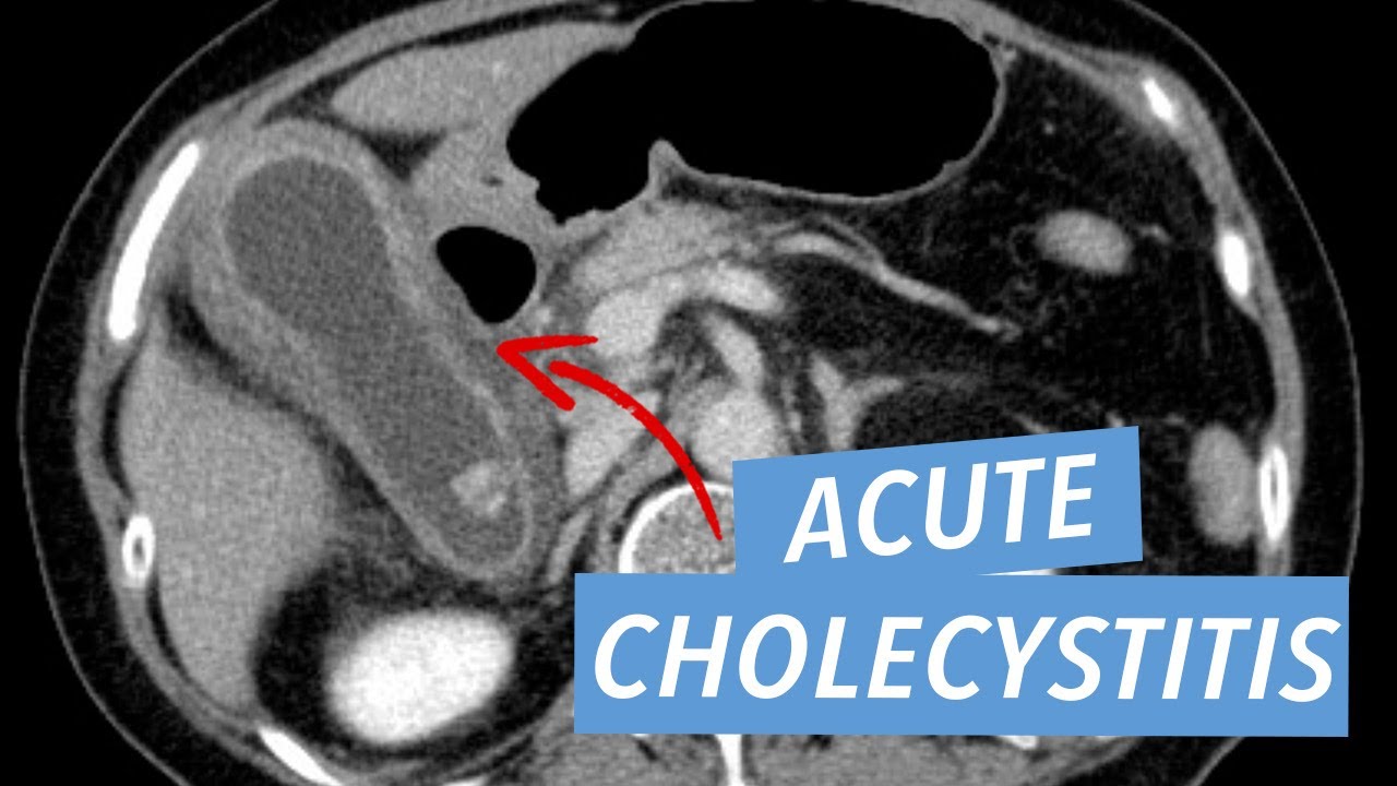 Acute Cholecystitis on CT and Ultrasound - YouTube