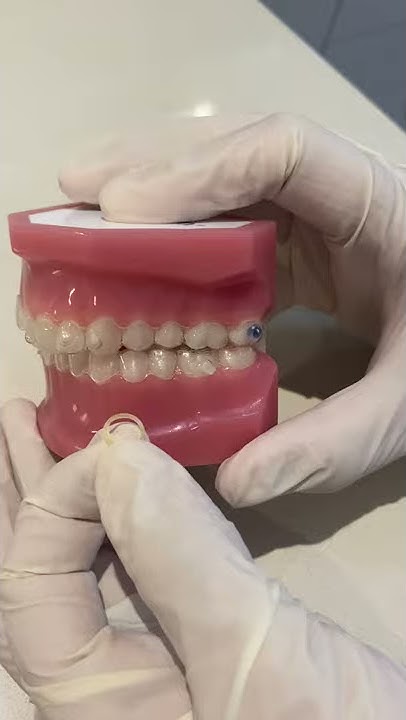 Class II Elastics with Invisalign - YouTube