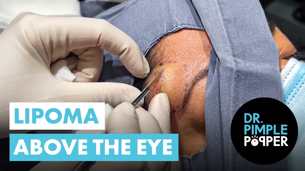 Removing a Lipoma Above the Eye | Safe Procedure Explained by Dr ...