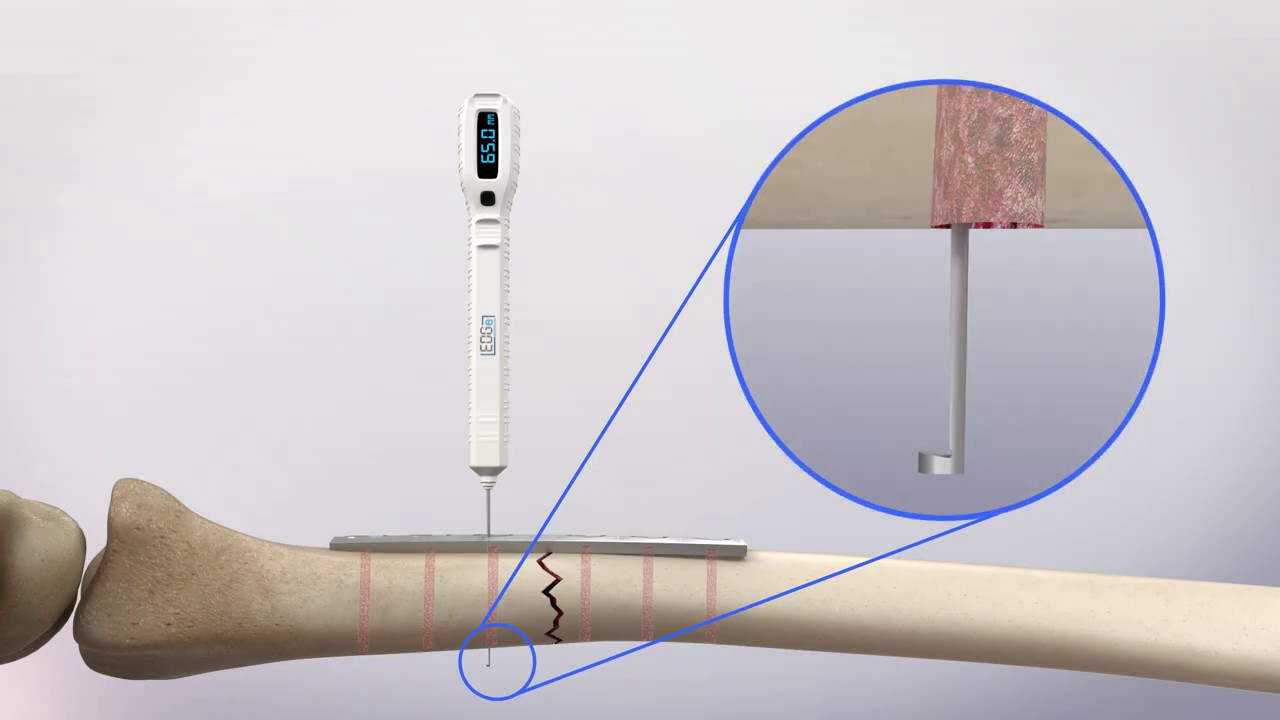 EDG® Ortho 65mm Universal Digital Depth Gauge by EDGe Surgical, Inc ...