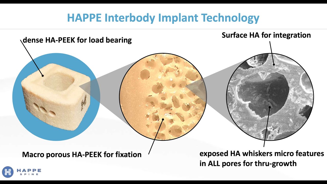 HAPPE Spine - Program Director Doug Snell - YouTube