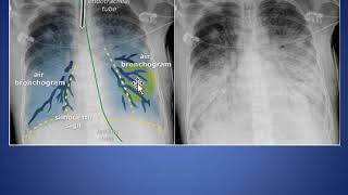 Air Bronchograms On Cxr