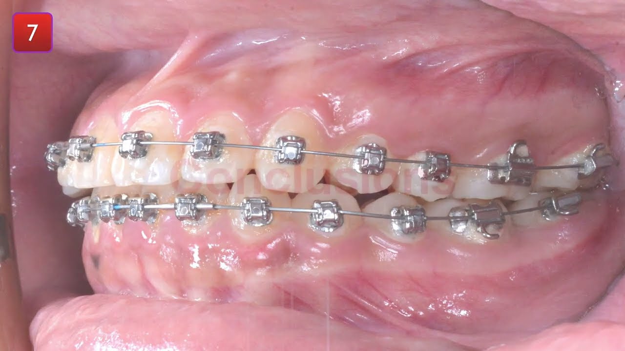 Simple Solution for the Palatally Impacted Upper 2nd Premolar｜【Chris ...