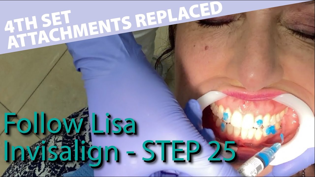 🦷 Invisalign 25 - Removal of attachments + 4th and final set of ...