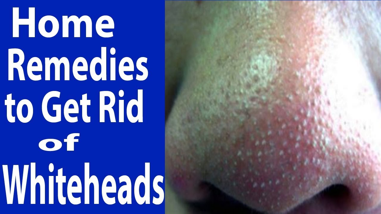 How to get rid of whiteheads naturally | How to remove whiteheads at ...