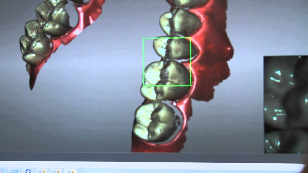 The CS 3600 intraoral scanner in action - YouTube
