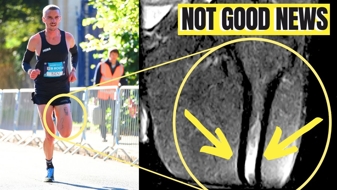 BEN IS INJURED (My First Major Running Injury) - YouTube