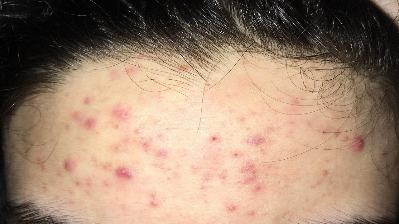 how to get rid of pimples without pimple patches - YouTube