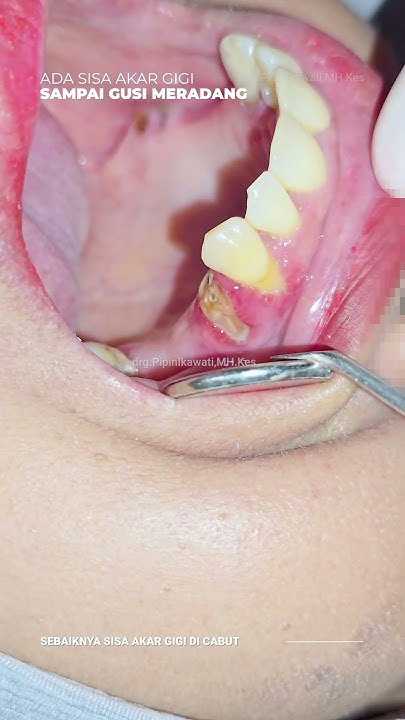 ADA SISA AKAR GIGI SAMPAI GUSI MERADANG - YouTube