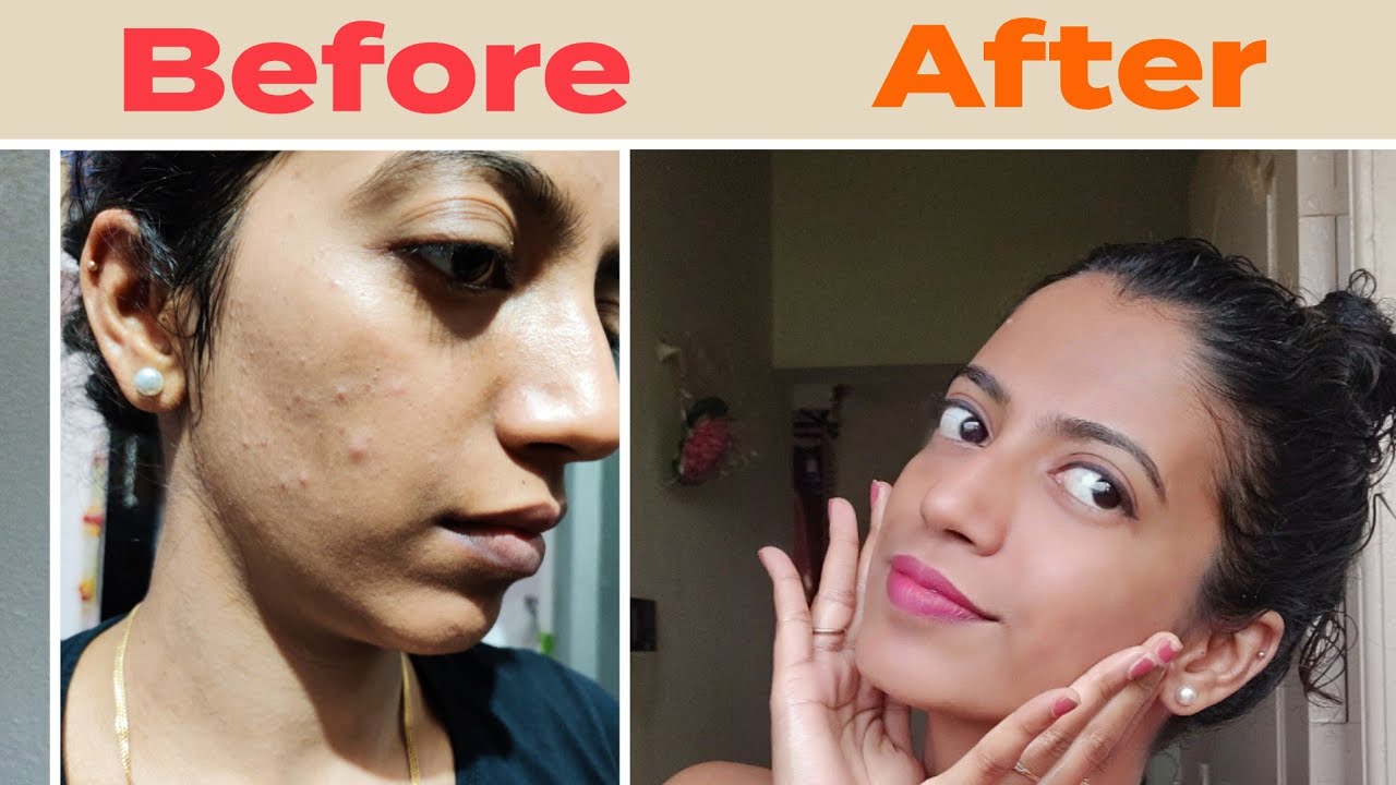 How to remove pimples overnight on Face and from your Head? - YouTube