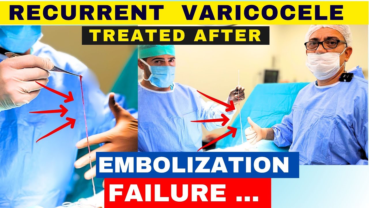 Recurrent Varicocele Finally Cured – Istanbul Technique After Failed ...