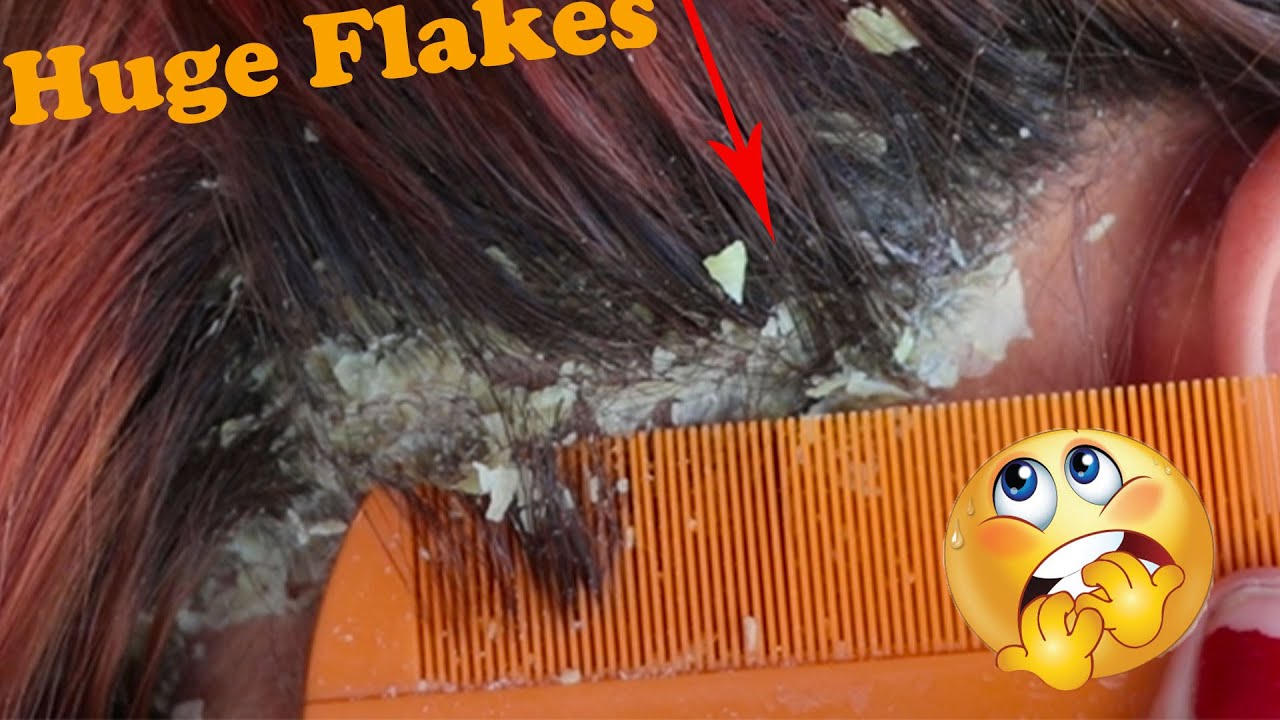 Dandruff Scratching Big Flakes No Talking Monster Flakes Picking And ...