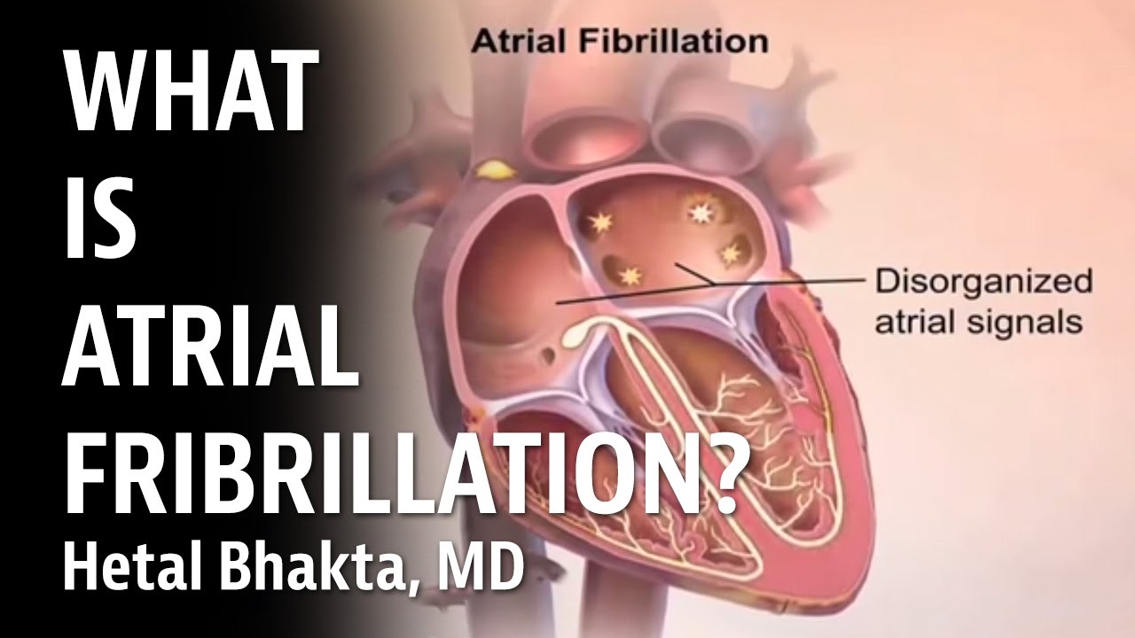 What is Atrial Fibrillation? - Hetal Bhakta, MD - YouTube