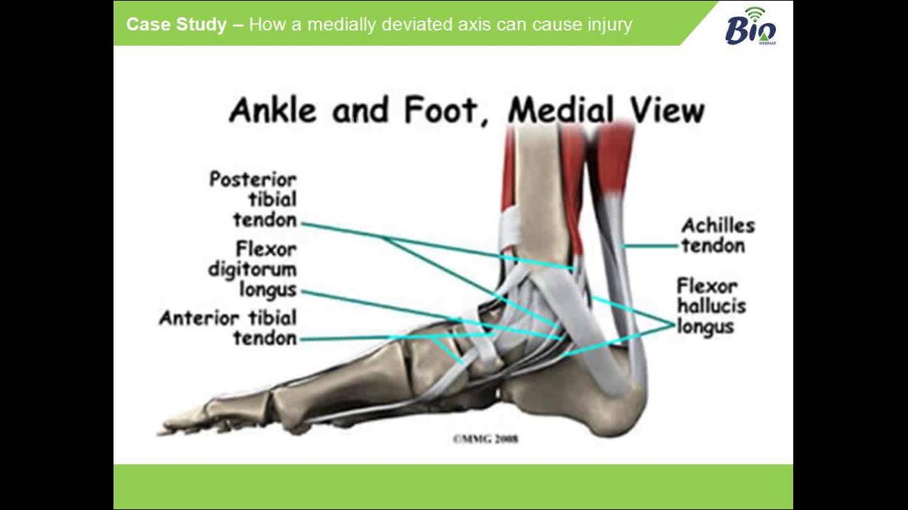 Medially Deviated Subtalar Joint Axis - Heidi Meckler - YouTube