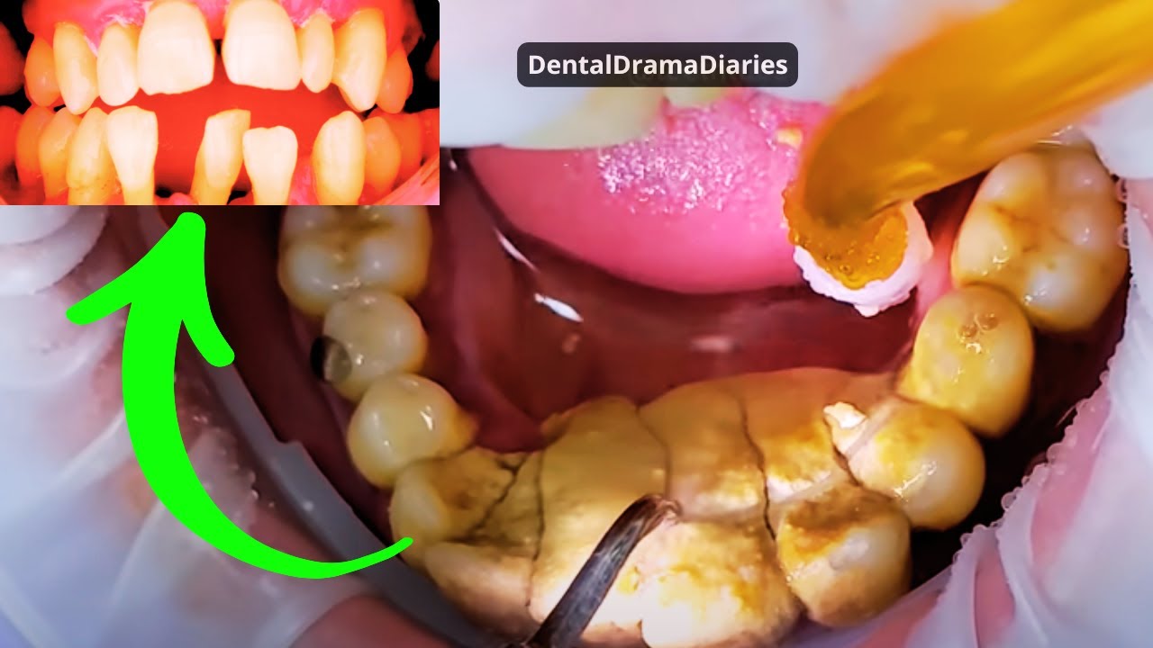 Removal of giant tartar from teeth in the mouth of a 47 year old man - scaling - YouTube