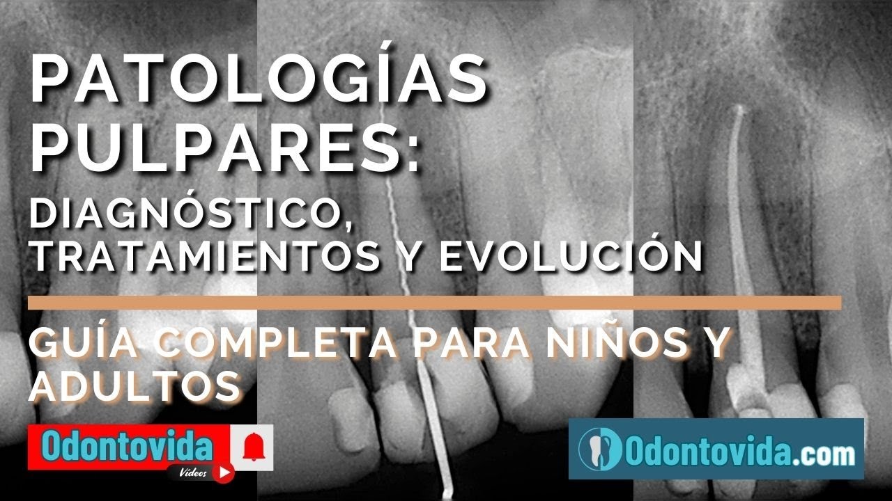 Patologías Pulpares: Diagnóstico, tratamientos y evolución. Guía ...
