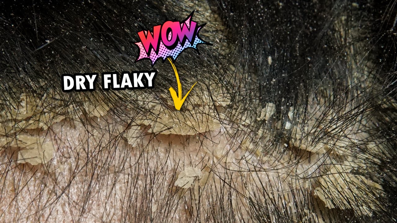 Dandruff Removal Dry Flaky Scalp!!! Dandruff Scratching #369 - YouTube