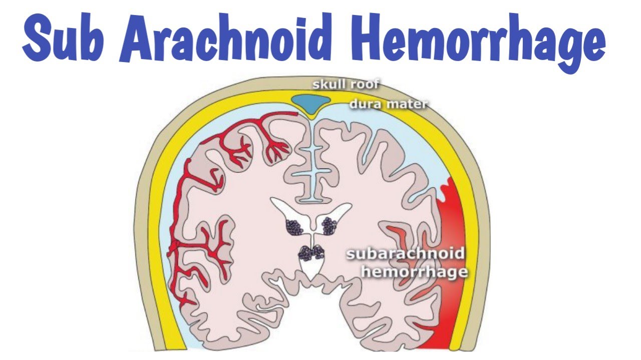 Sub Arachnoid Hemorrhage || සිංහලෙන් - YouTube